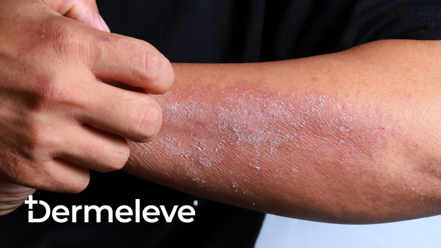Scabies or Eczema: Understanding the Treatment of Scabies – Dermeleve®